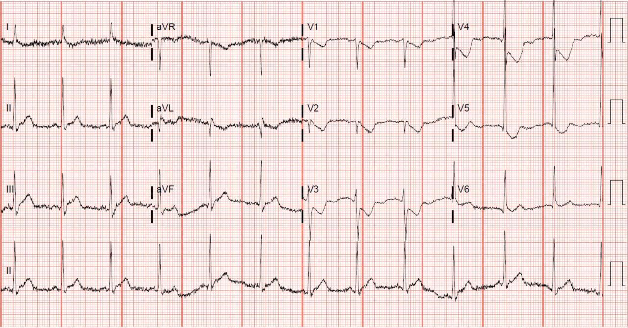 ECG Assessment | ECG Stampede