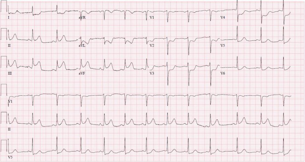 ECG Assessment | ECG Stampede