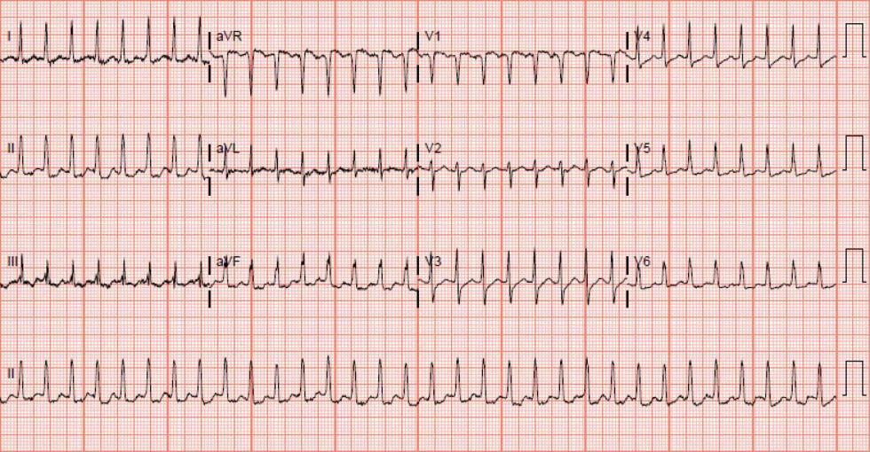 ECG Assessment | ECG Stampede