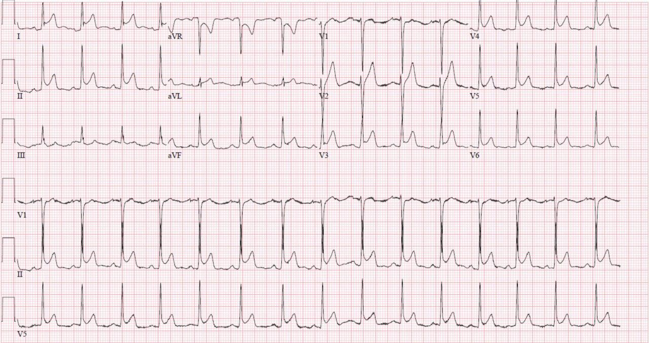 ECG Assessment | ECG Stampede