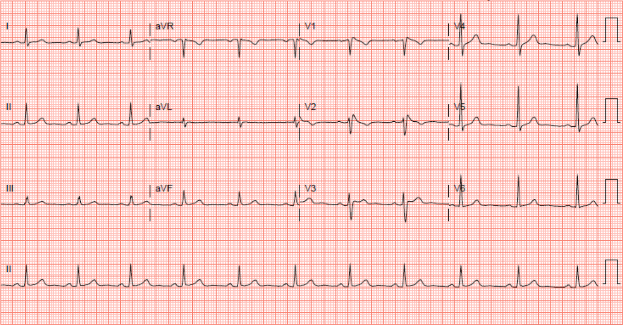 ECG Assessment | ECG Stampede