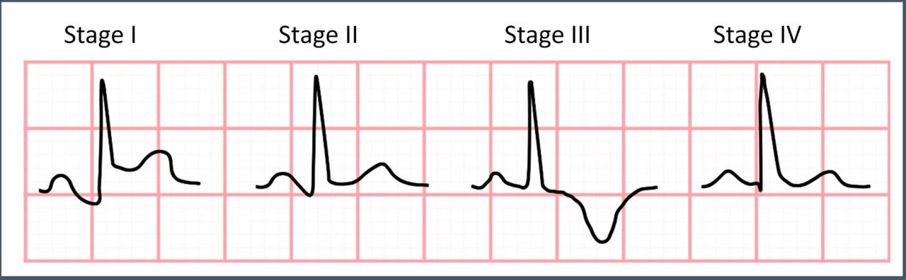 JUCM: ECG Challenge #3 | ECG Stampede