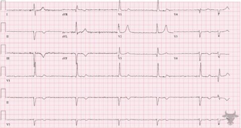 Third Degree Atrioventricular Block | ECG Stampede
