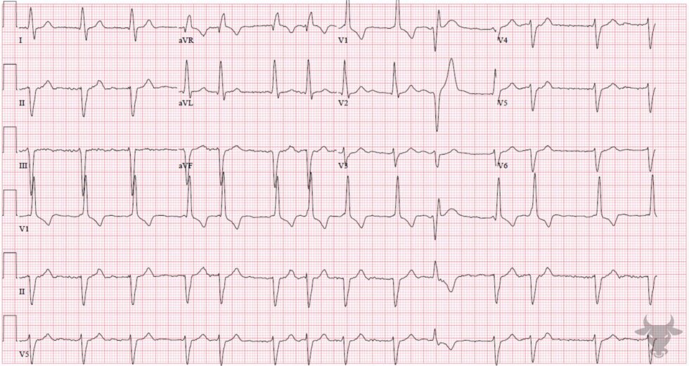 Atrial Fibrillation | ECG Stampede