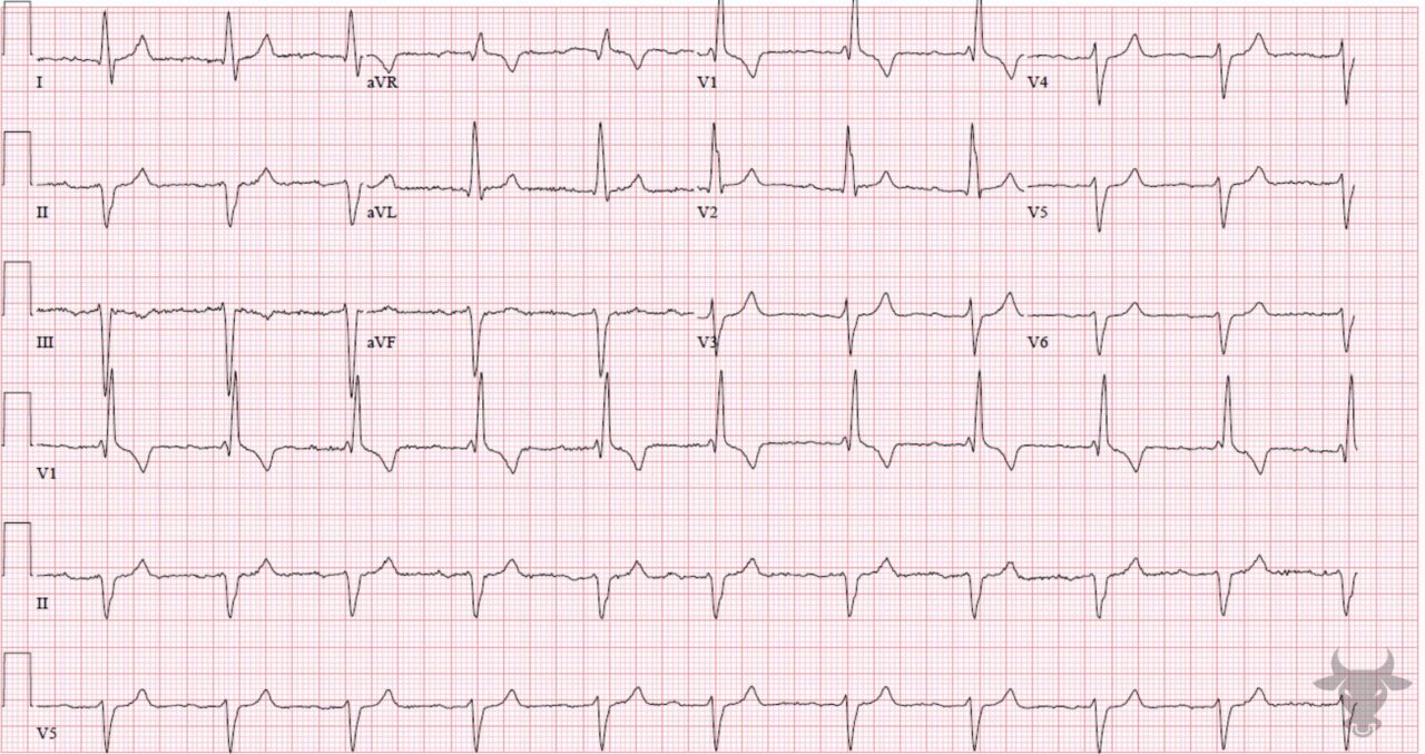 Right Bundle Branch Block | ECG Stampede