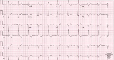 Trifascicular Block | ECG Stampede