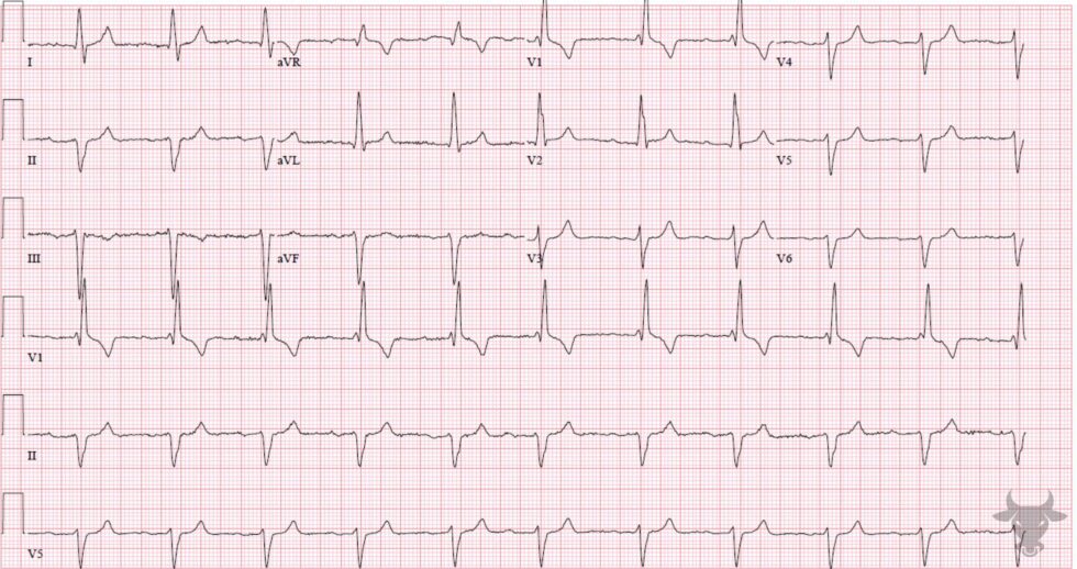 First Degree Atrioventricular Block | ECG Stampede