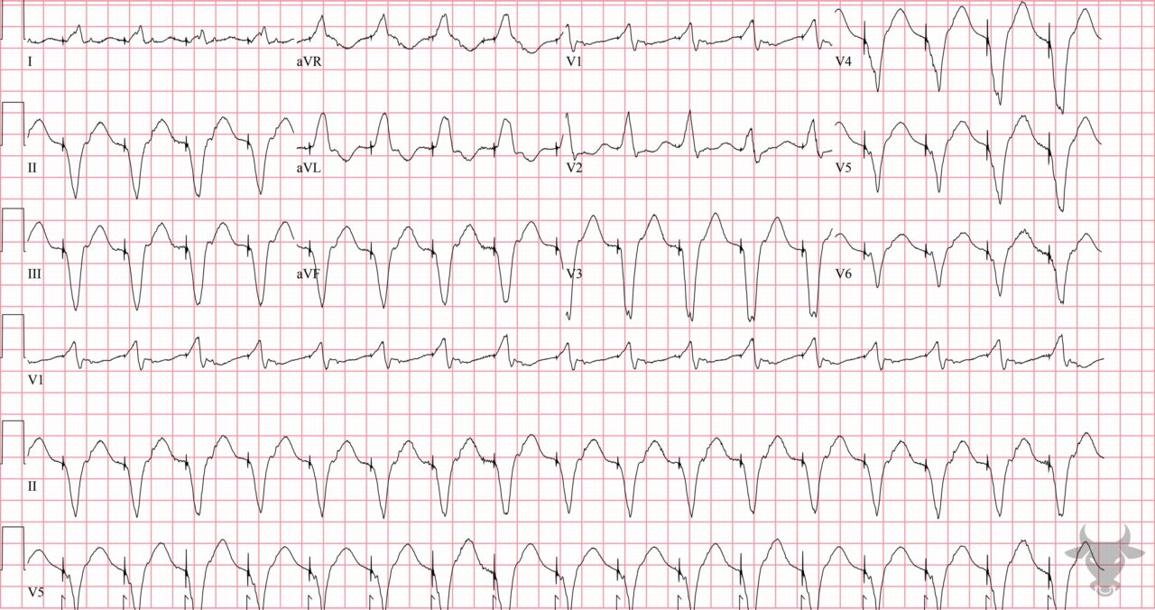 Pacemaker Mediated Tachycardia | ECG Stampede