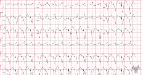 Pacemaker Mediated Tachycardia | ECG Stampede