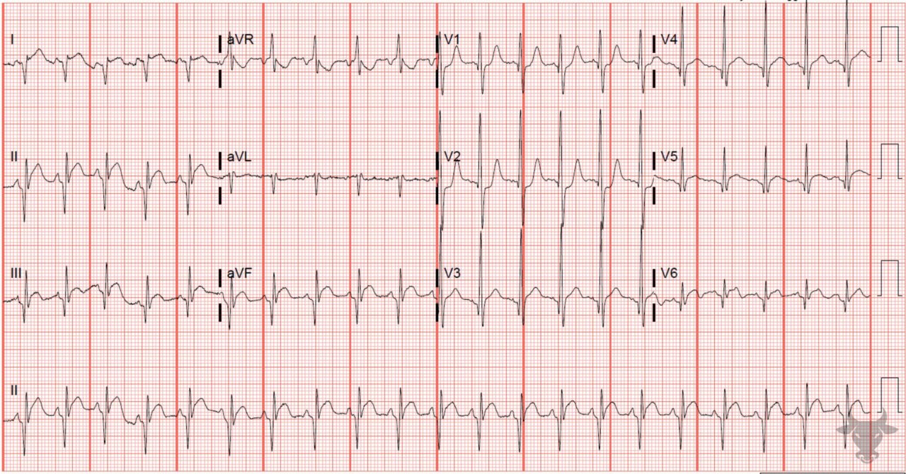 Dextrocardia | ECG Stampede
