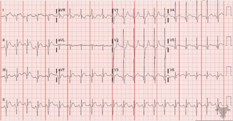 Dextrocardia | ECG Stampede