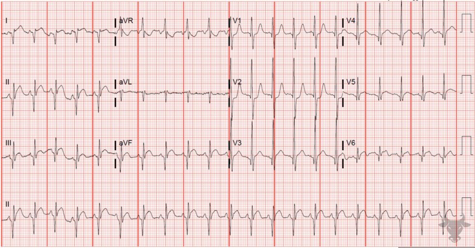 Dextrocardia | ECG Stampede