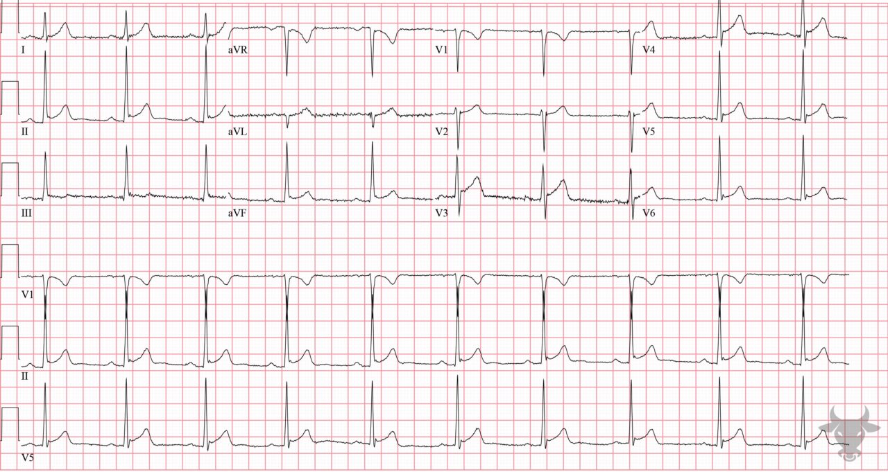 Early Repolarization | ECG Stampede