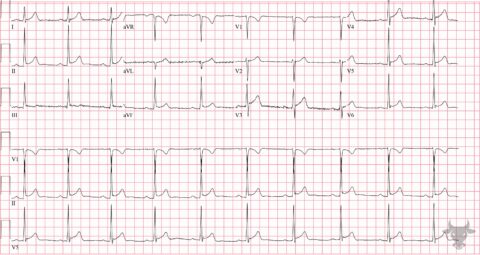 Early Repolarization | ECG Stampede