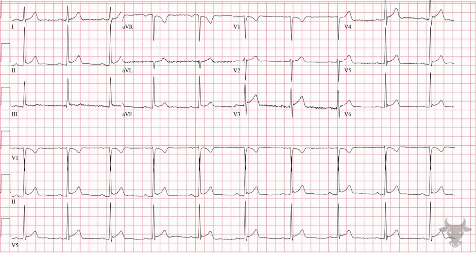 Early Repolarization | ECG Stampede