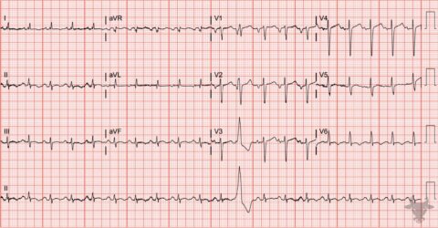 Left Atrial Enlargement | ECG Stampede