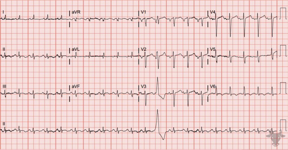 Left Atrial Enlargement | ECG Stampede