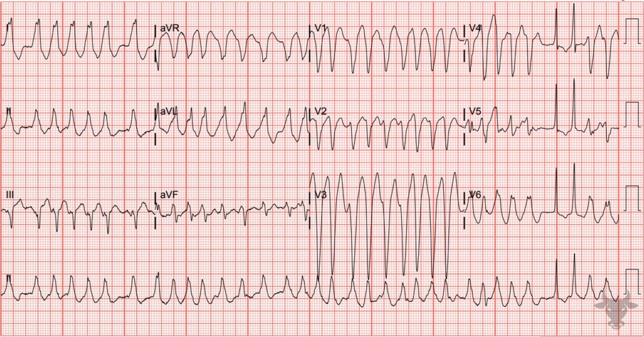 Ventricular Pre-excitation | ECG Stampede