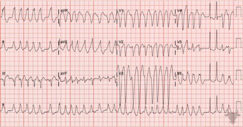 Ventricular Pre-excitation | ECG Stampede
