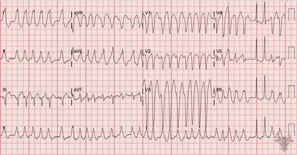 Atrial Fibrillation | ECG Stampede