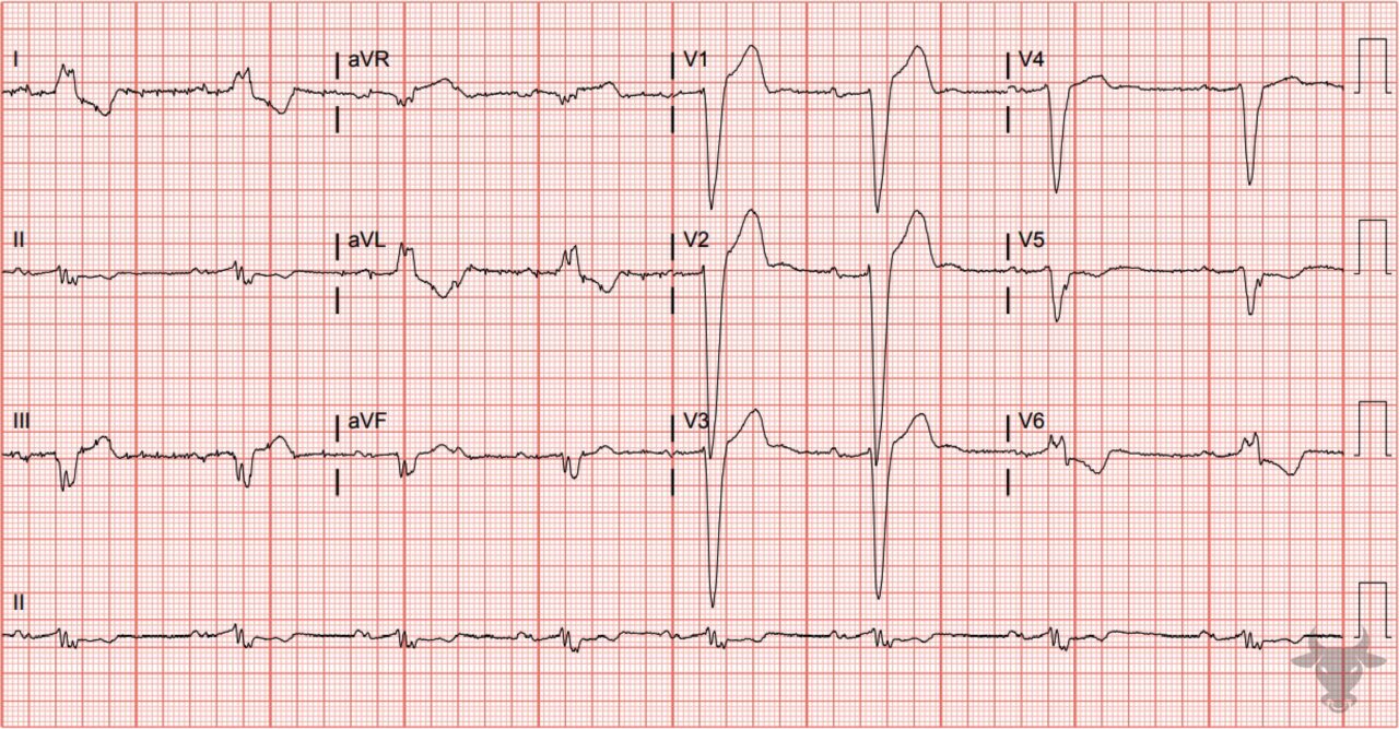 Left Bundle Branch Block | ECG Stampede