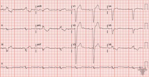 Left Bundle Branch Block | ECG Stampede