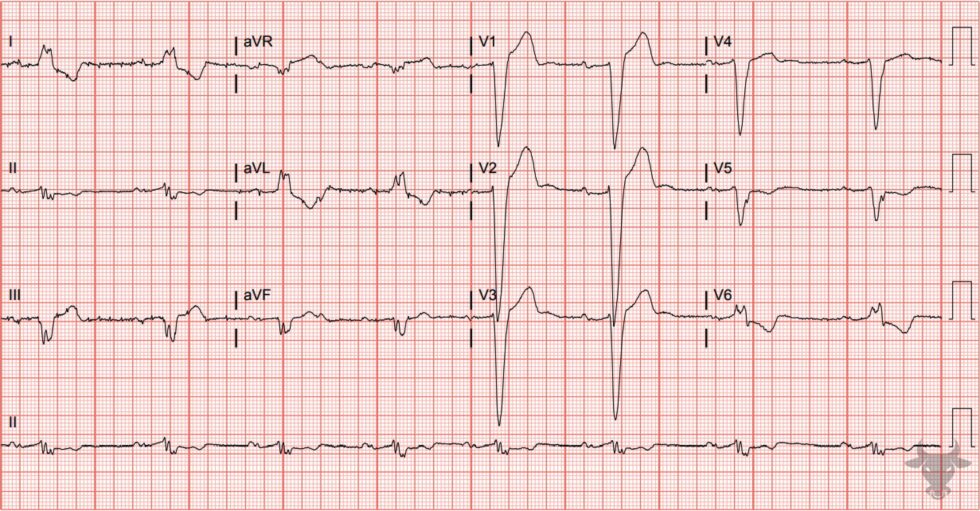 Left Bundle Branch Block | ECG Stampede