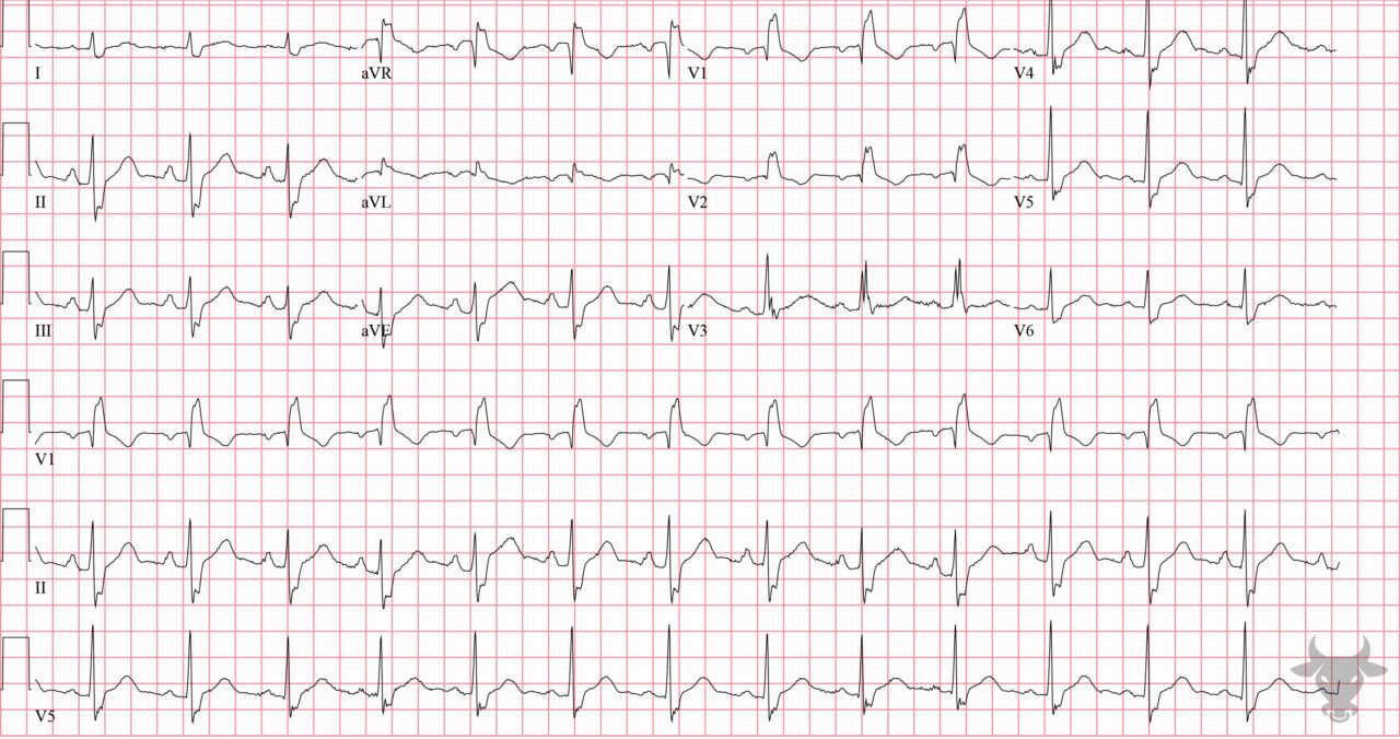 Right Bundle Branch Block | ECG Stampede