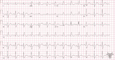 Right Bundle Branch Block | ECG Stampede