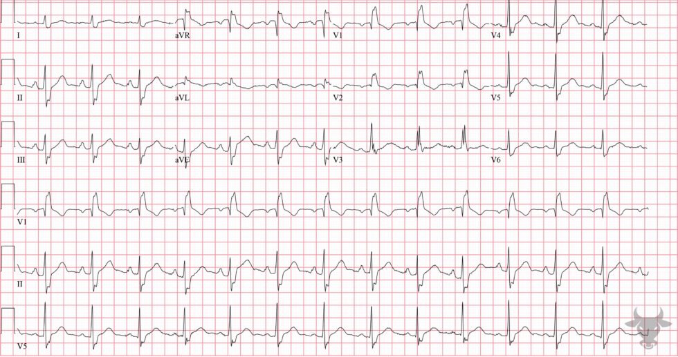Right Bundle Branch Block | ECG Stampede