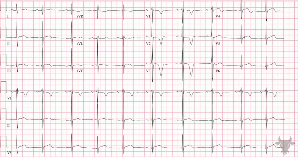 Hypertrophic Cardiomyopathy | ECG Stampede
