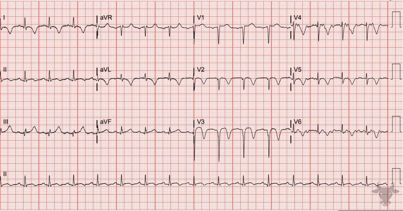Wellens Syndrome | ECG Stampede