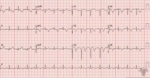 Wellens Syndrome | ECG Stampede