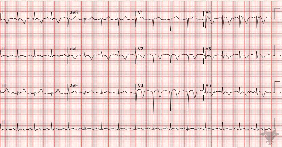 Wellens Syndrome | ECG Stampede