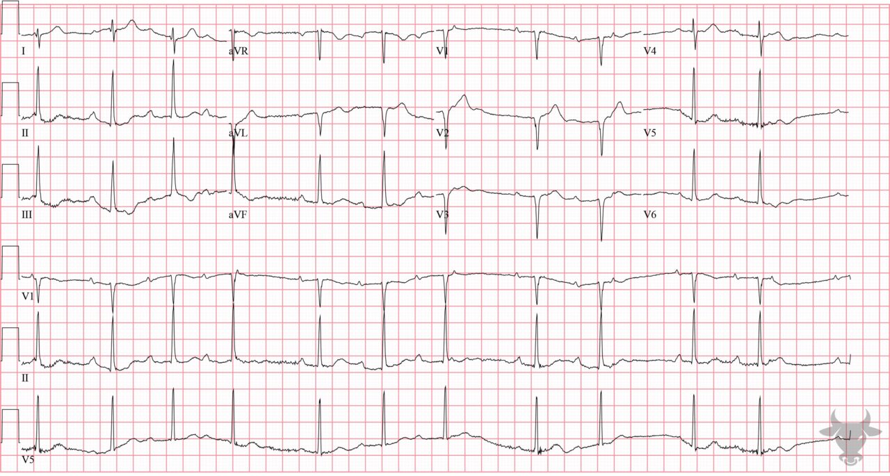 Second Degree Atrioventricular Block Mobitz I Ecg Stampede