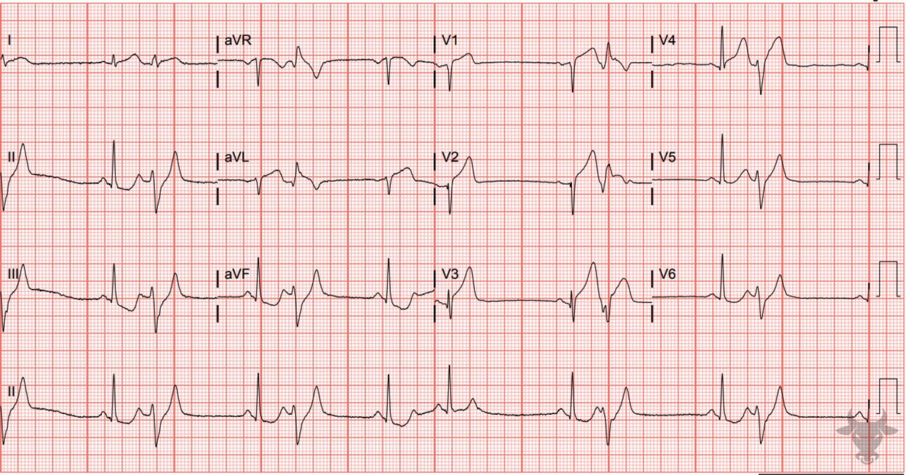 ST-elevation Myocardial Infarction | ECG Stampede