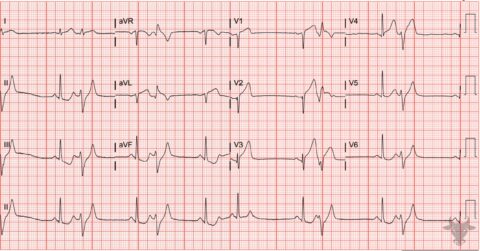 ST-elevation Myocardial Infarction | ECG Stampede