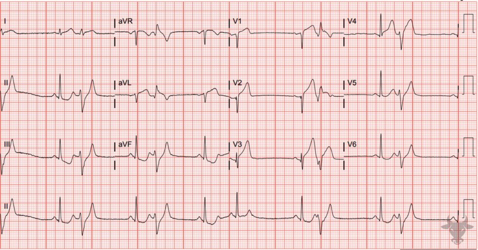 ST-elevation Myocardial Infarction | ECG Stampede