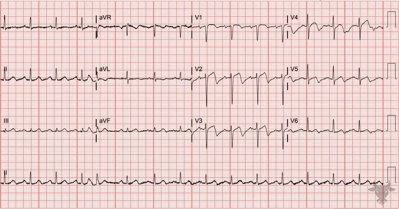 Wellens Syndrome | ECG Stampede