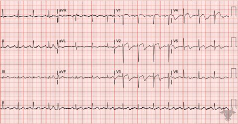 T-wave Inversions | ECG Stampede