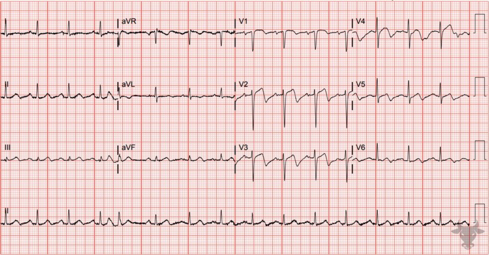 T-wave Inversions | ECG Stampede