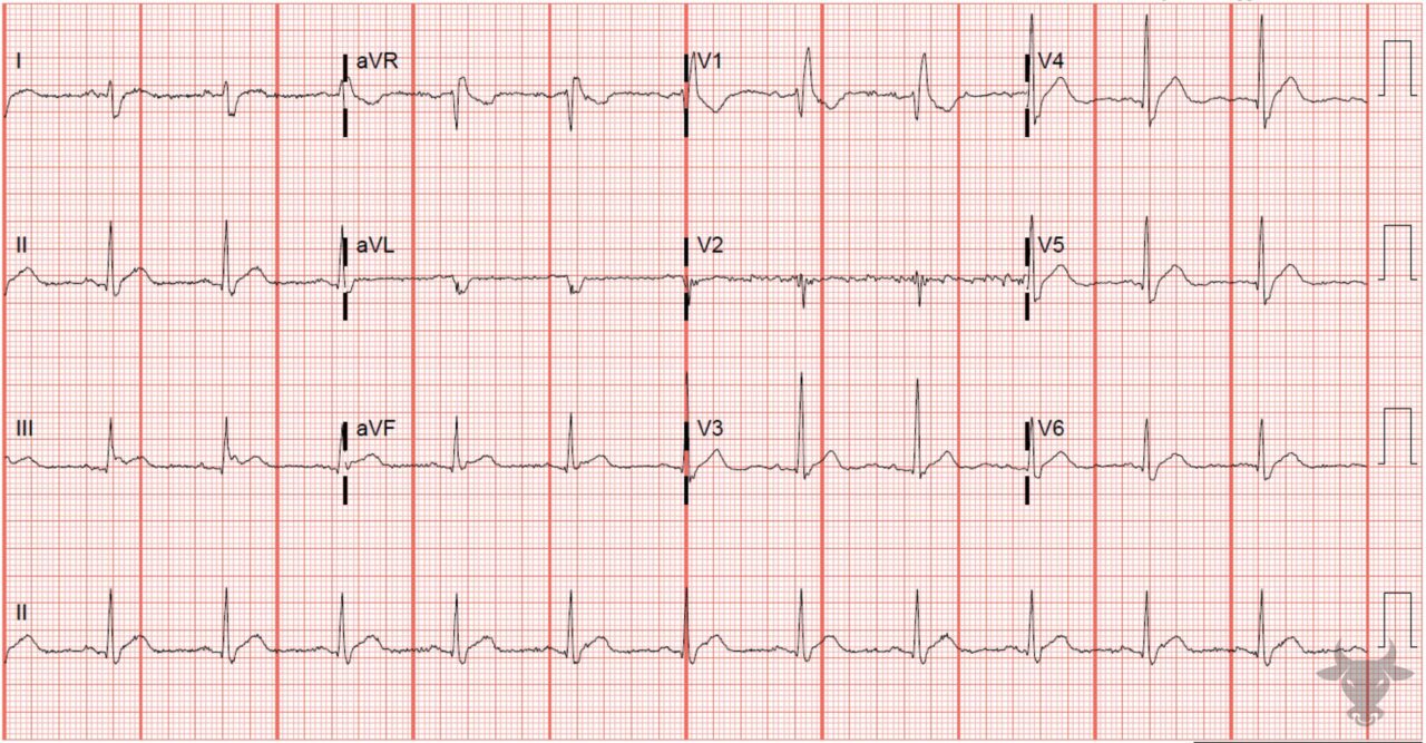 Hypercalcemia | ECG Stampede