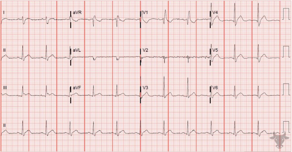 Hypercalcemia | ECG Stampede