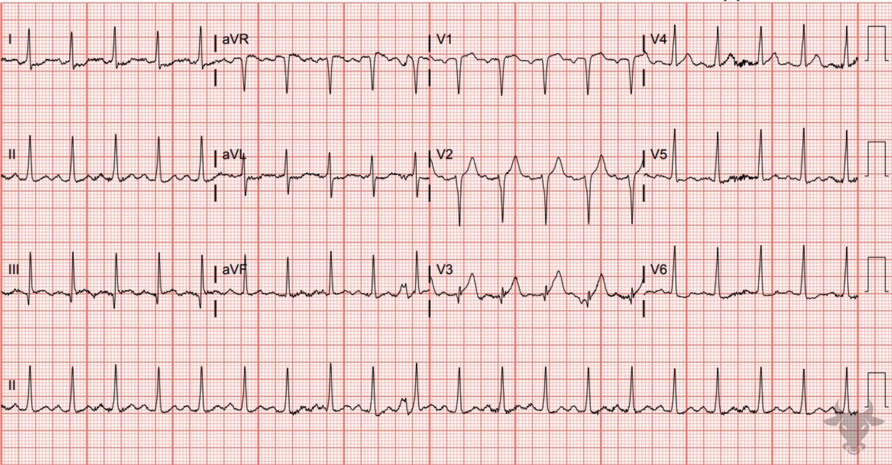 ST-elevation Myocardial Infarction | ECG Stampede