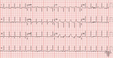 ST-elevation Myocardial Infarction | ECG Stampede