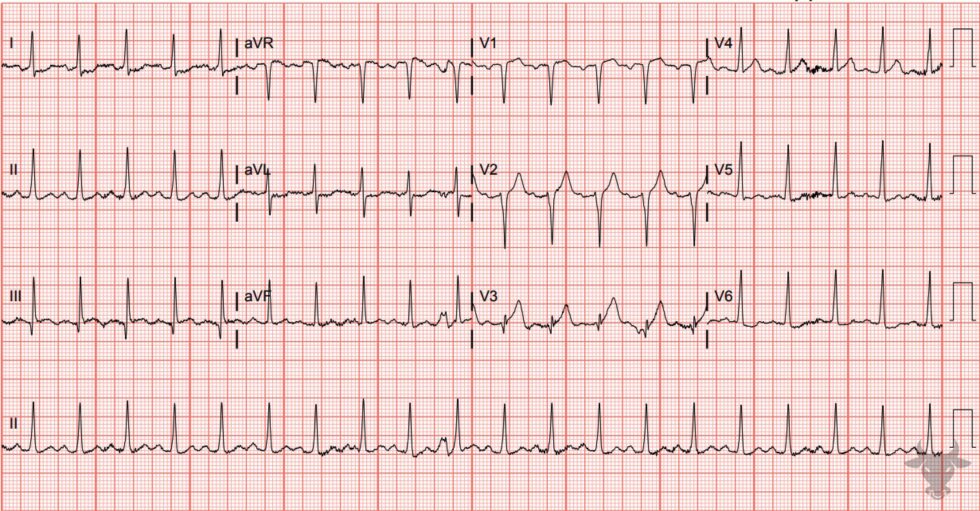 ST-elevation Myocardial Infarction | ECG Stampede
