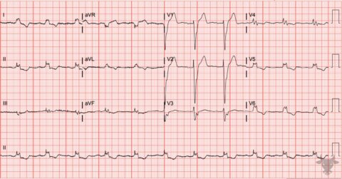 Left Bundle Branch Block | ECG Stampede
