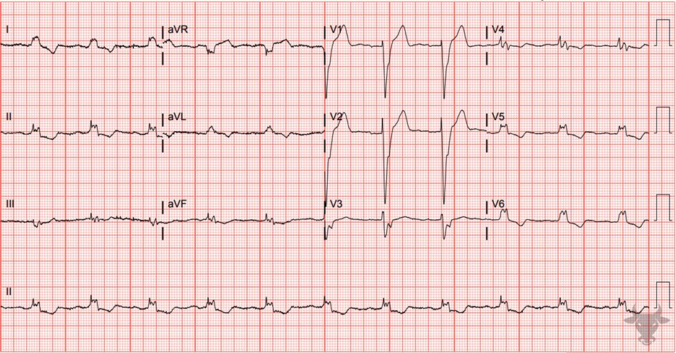 Left Bundle Branch Block | ECG Stampede