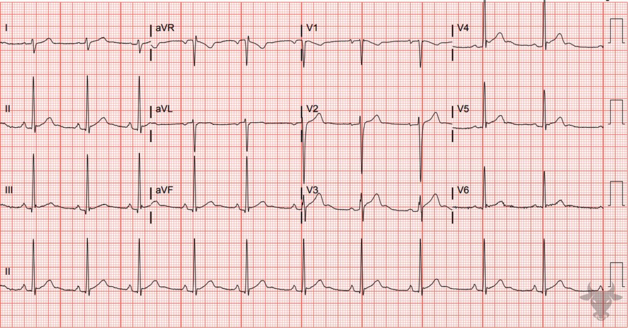 Early Repolarization | ECG Stampede