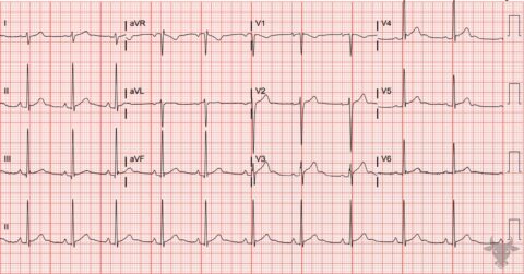 Early Repolarization | ECG Stampede